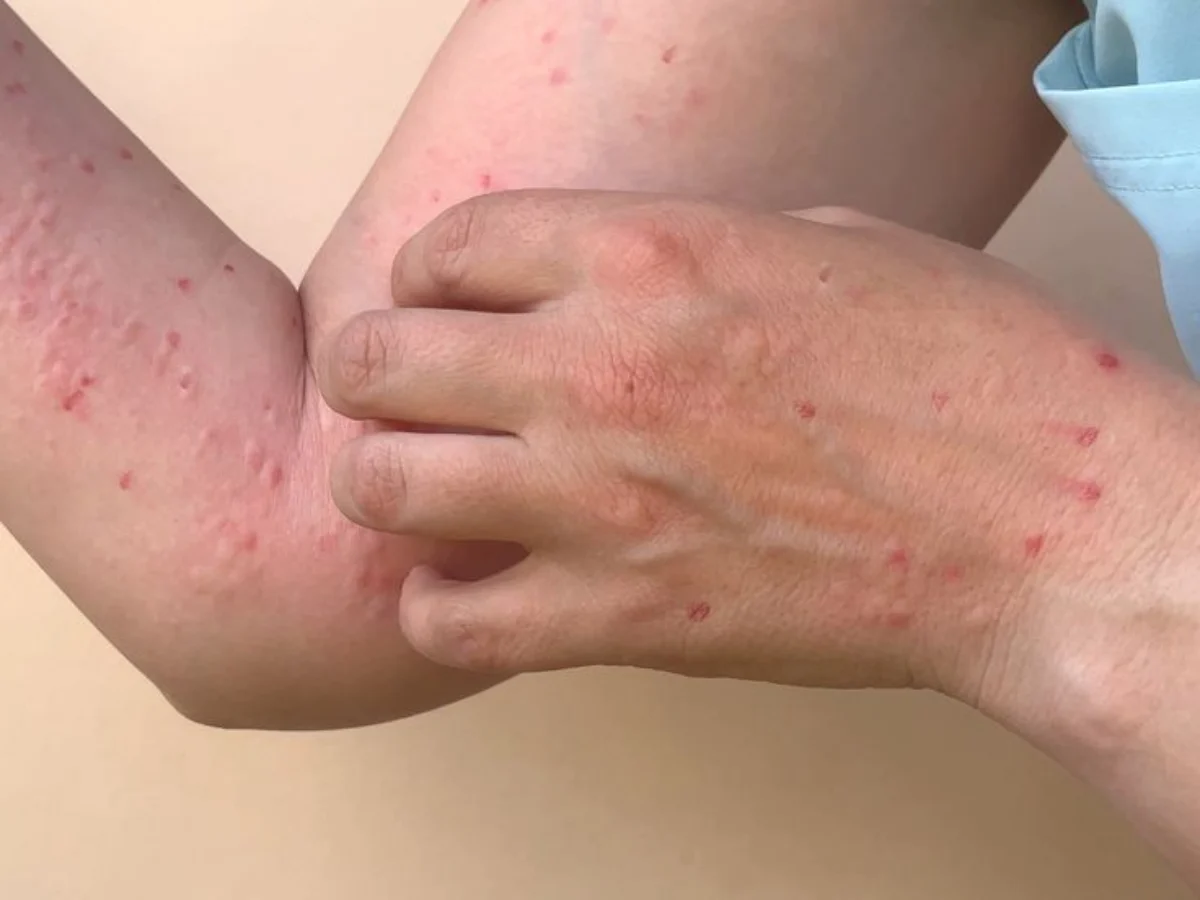 Mengenal Monkeypox dan Cara Penanganannya yang Benar dan Perlu Anda ...