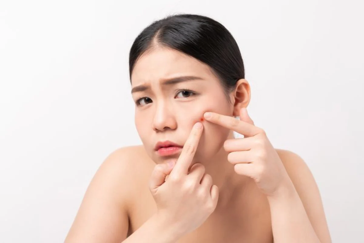 Tips Mencegah Purging pada Wajah Setelah Menggunakan Skincare Baru – Rakcer.ID